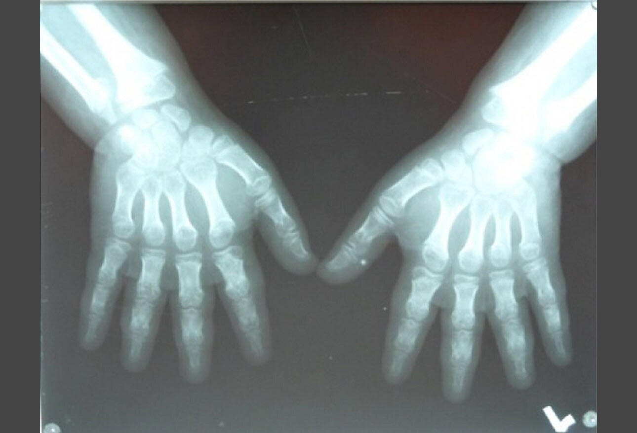 Understanding Growth Disorders: 7 Cases