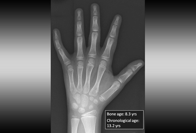 Understanding Growth Disorders: 7 Cases