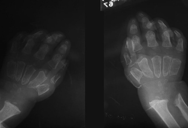 Understanding Growth Disorders: 7 Cases