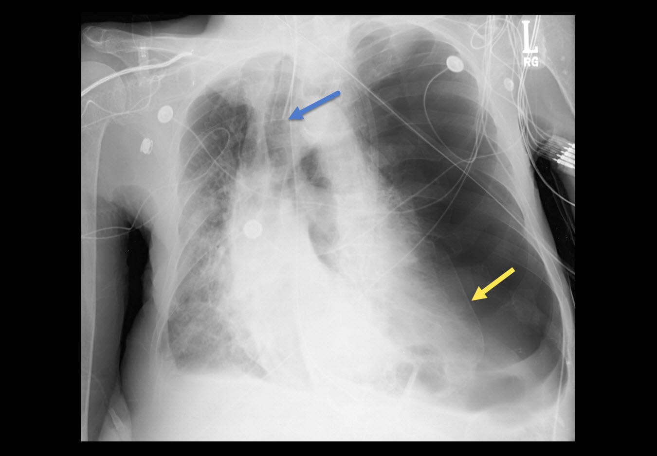 Gunshot Wounds: A Targeted Approach