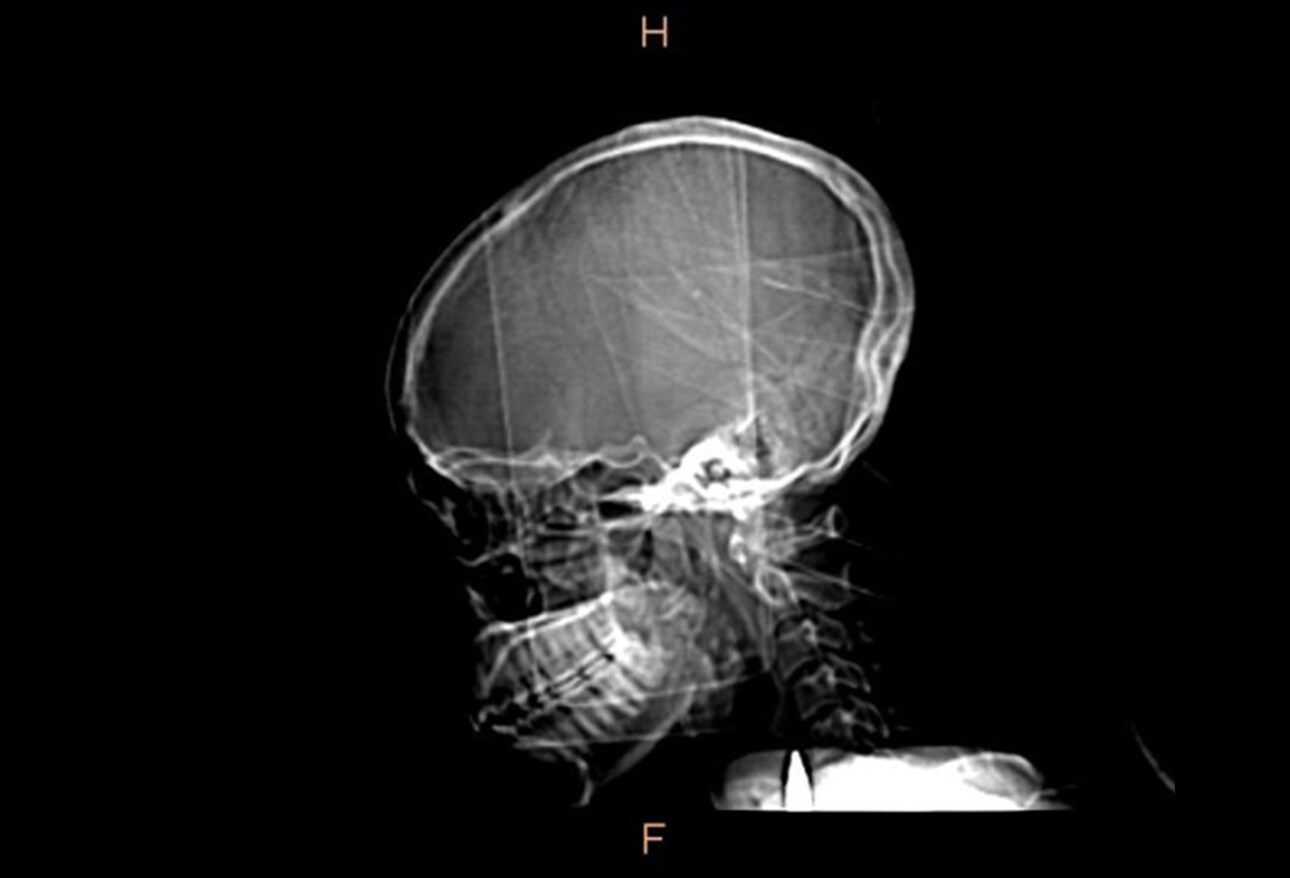 Gunshot Wounds: Damage and Death