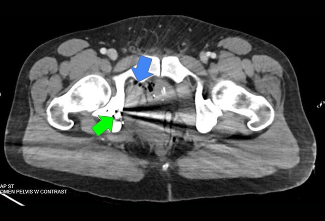 Gunshot Wounds: Damage and Death