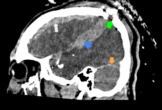 Gunshot Wounds: Damage and Death