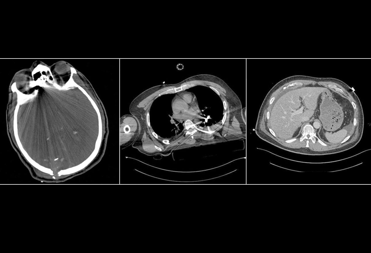 Gunshot Wounds: Damage and Death