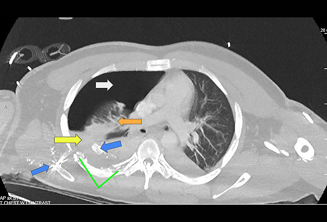 Gunshot Wounds: Damage and Death