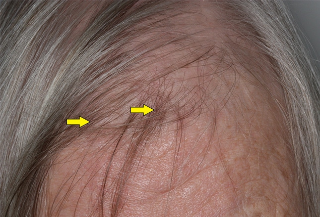 Hair Disorders: Finding the Root of the Problem