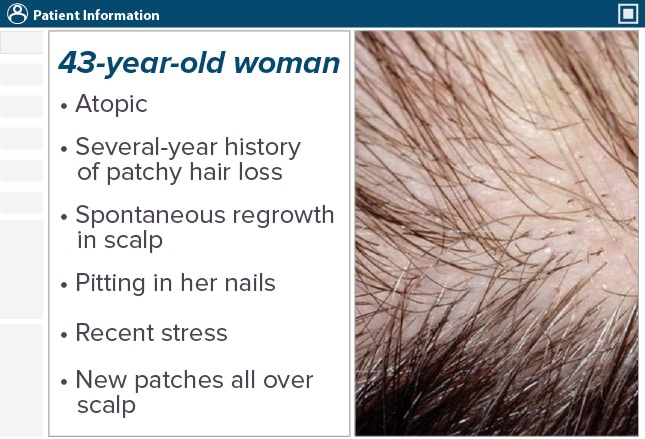 Hair Disorders: Finding the Root of the Problem