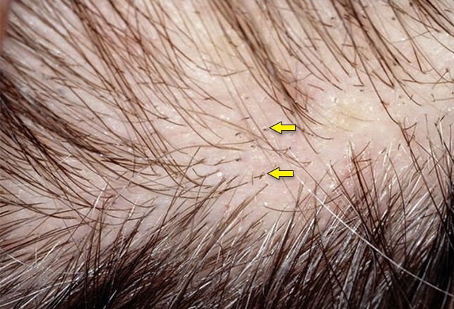 Hair Disorders: Finding the Root of the Problem