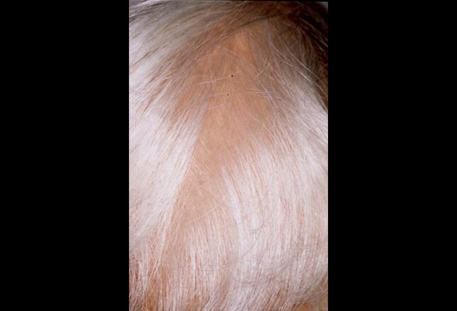 Hair Disorders: Finding the Root of the Problem