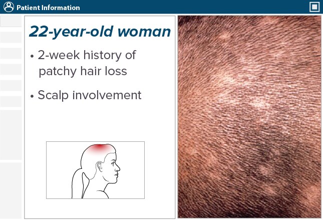 Hair Disorders: Finding the Root of the Problem
