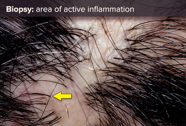 Hair Disorders: Finding the Root of the Problem