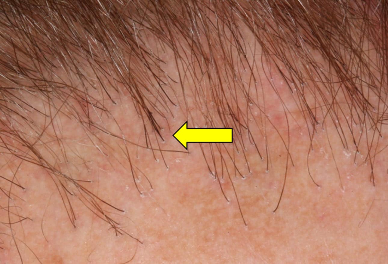 Hair Disorders: Finding the Root of the Problem