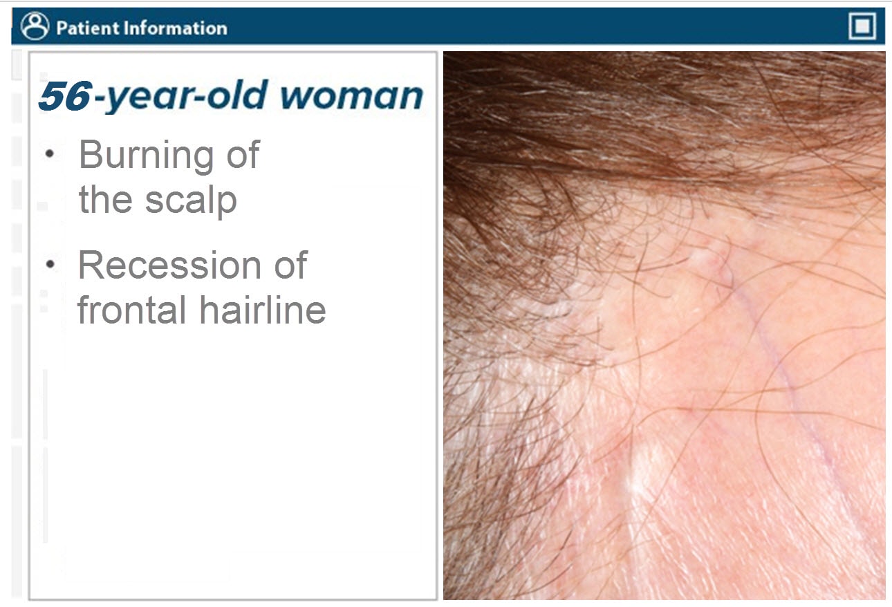 Hair Disorders: Finding the Root of the Problem