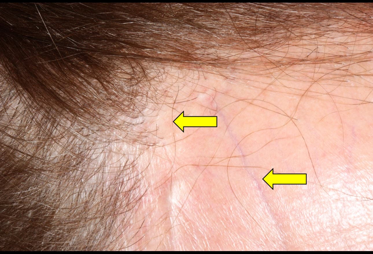 Hair Disorders: Finding the Root of the Problem