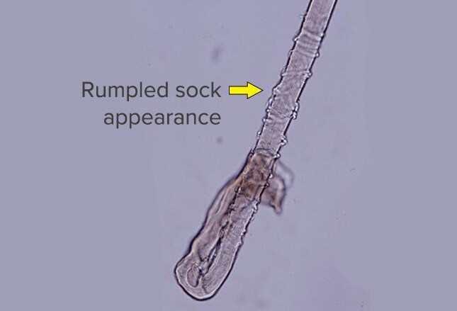 Hair Disorders: Finding the Root of the Problem