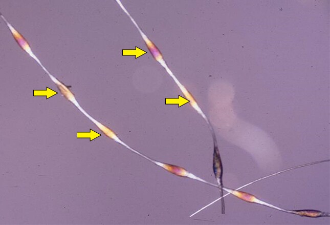 Hair Disorders: Finding the Root of the Problem