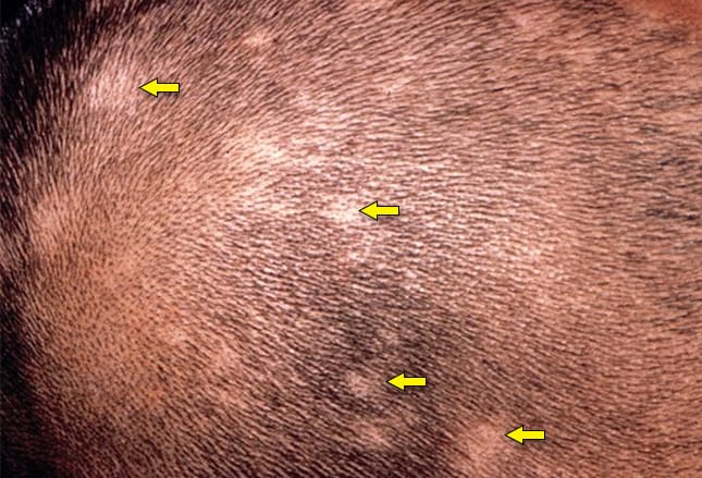 Hair Disorders: Finding the Root of the Problem