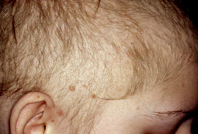 Hair Disorders: Finding the Root of the Problem