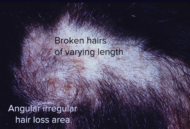 Hair Disorders: Finding the Root of the Problem