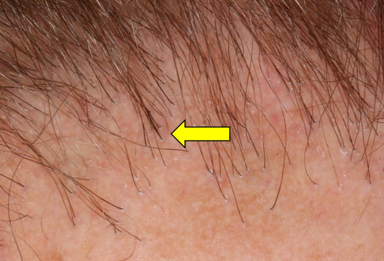 Hair Disorders: Finding the Root of the Problem