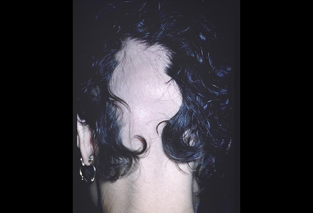 Hair Disorders: Finding the Root of the Problem