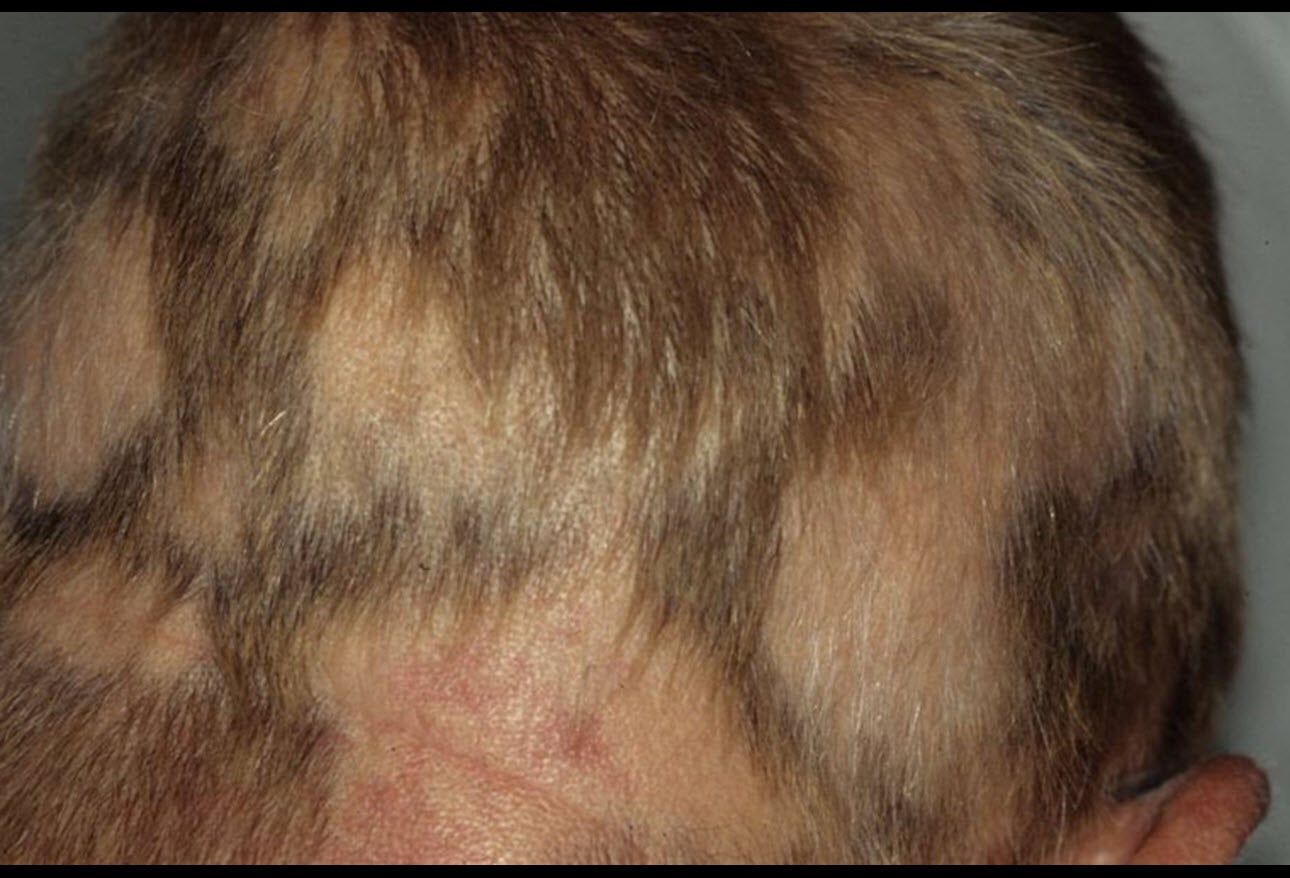 Hair Disorders: Finding the Root of the Problem