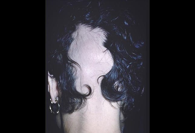 Hair Disorders: Finding the Root of the Problem