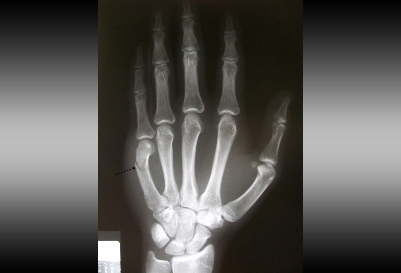 14 Can't-Miss Hand Emergencies