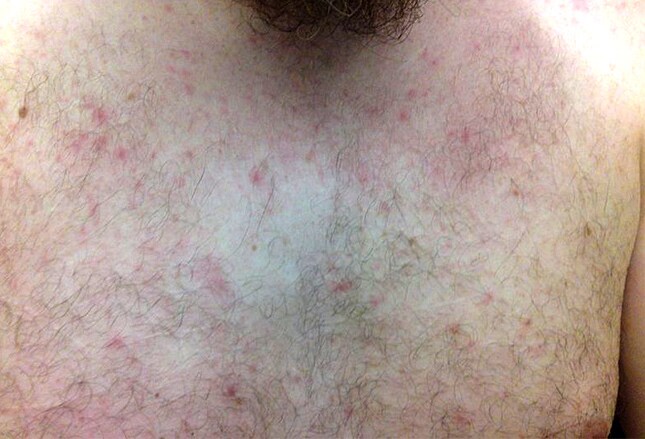 Burning Up? A Guide To Recognizing And Managing Heat Illness