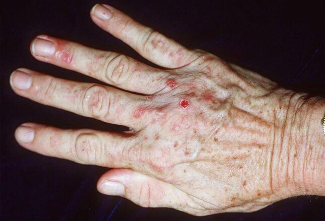 Hepatitis C: Cure Is About More Than the Liver