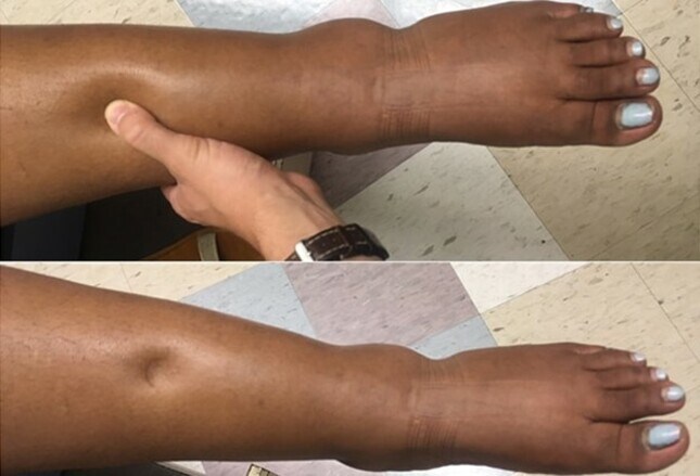 Dermatologic Hints to Hidden Heart Disease