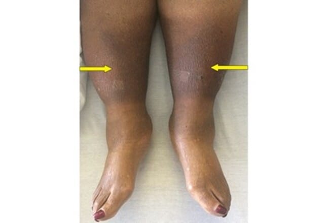 Dermatologic Hints to Hidden Heart Disease