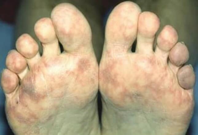 Dermatologic Hints to Hidden Heart Disease