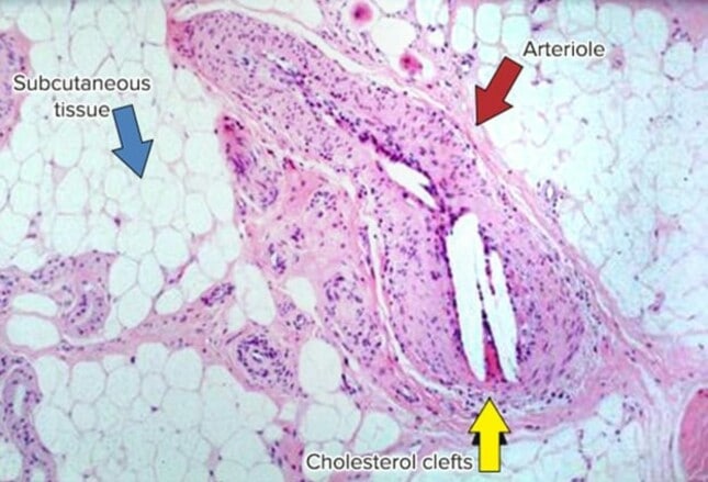 Dermatologic Hints to Hidden Heart Disease