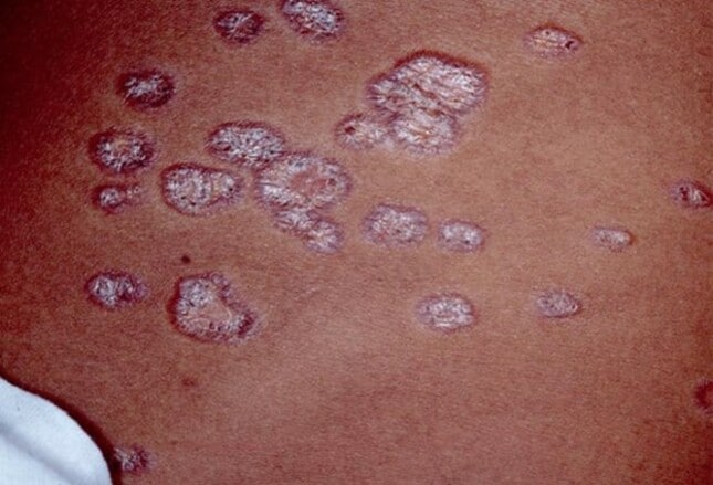 Dermatologic Hints to Hidden Heart Disease