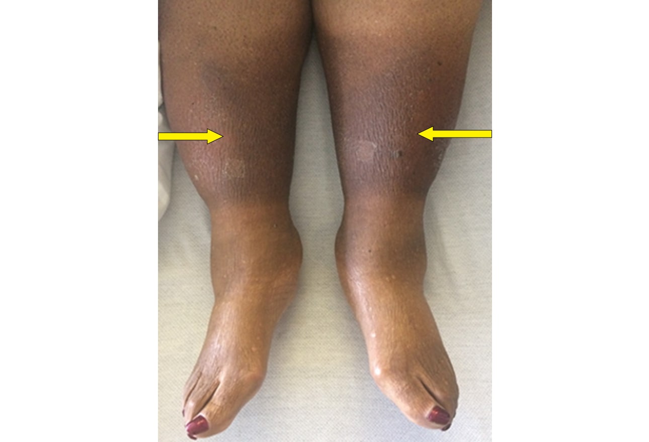 Hidden Heart Disease: Dermatologic Clues You Should Know