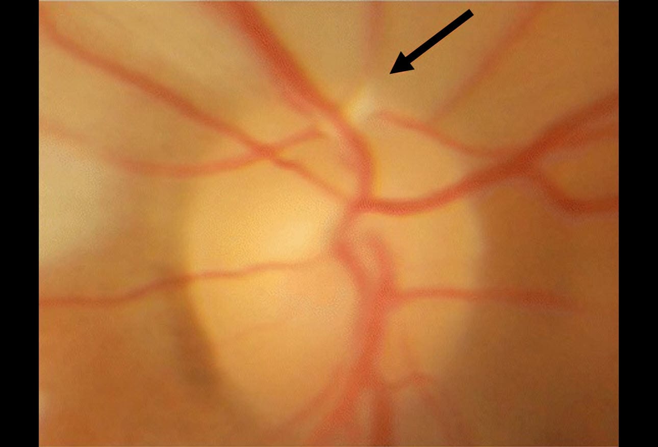 Hidden Heart Disease: Dermatologic Clues You Should Know