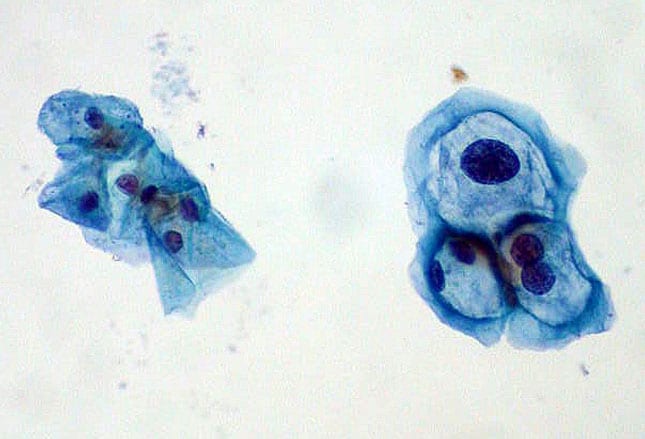 HPV Diseases: From Cutaneous to Anogenital to Epidermodysplasia ...