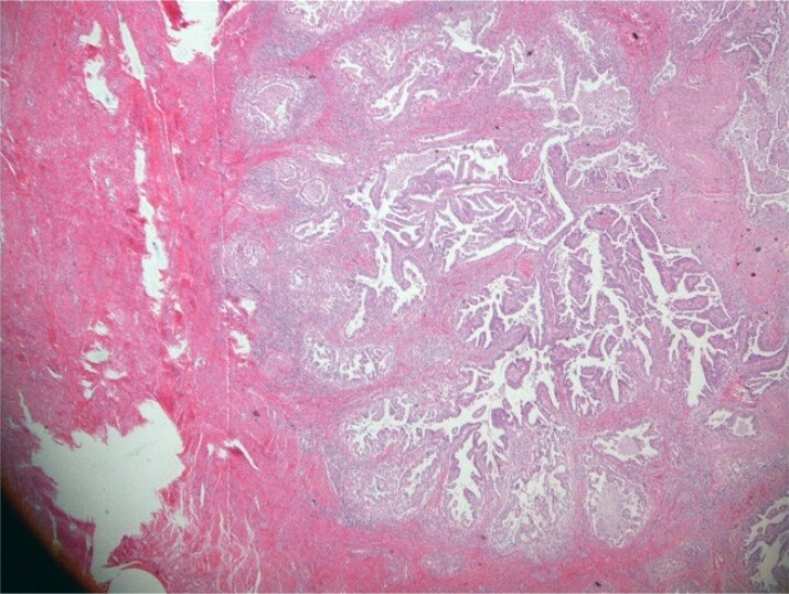 HPV Diseases: From Cutaneous to Anogenital to Epidermodysplasia ...