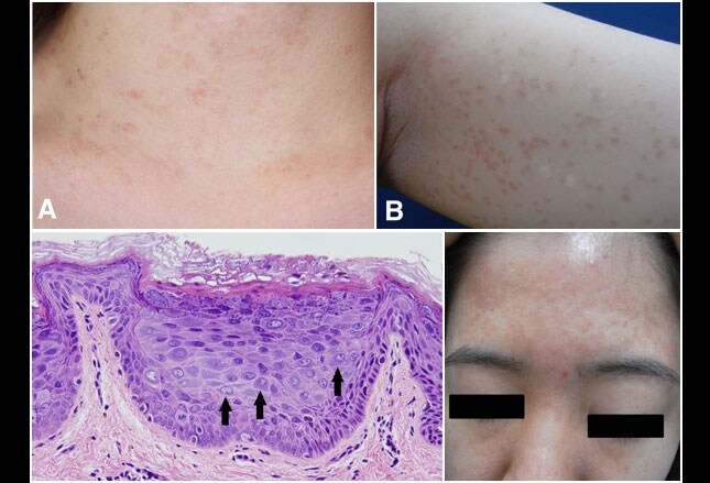 HPV Diseases: From Cutaneous to Anogenital to Epidermodysplasia ...