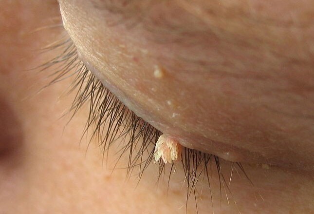 HPV Diseases: From Cutaneous to Anogenital to Epidermodysplasia ...