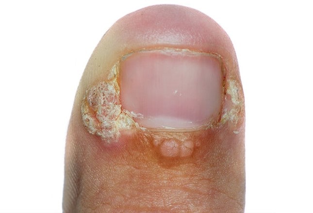 HPV Diseases: From Cutaneous to Anogenital to Epidermodysplasia ...