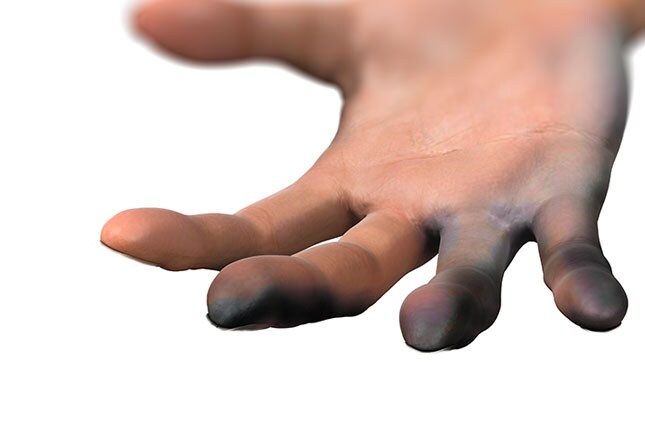 Hypothermia and Localized Cold Injury