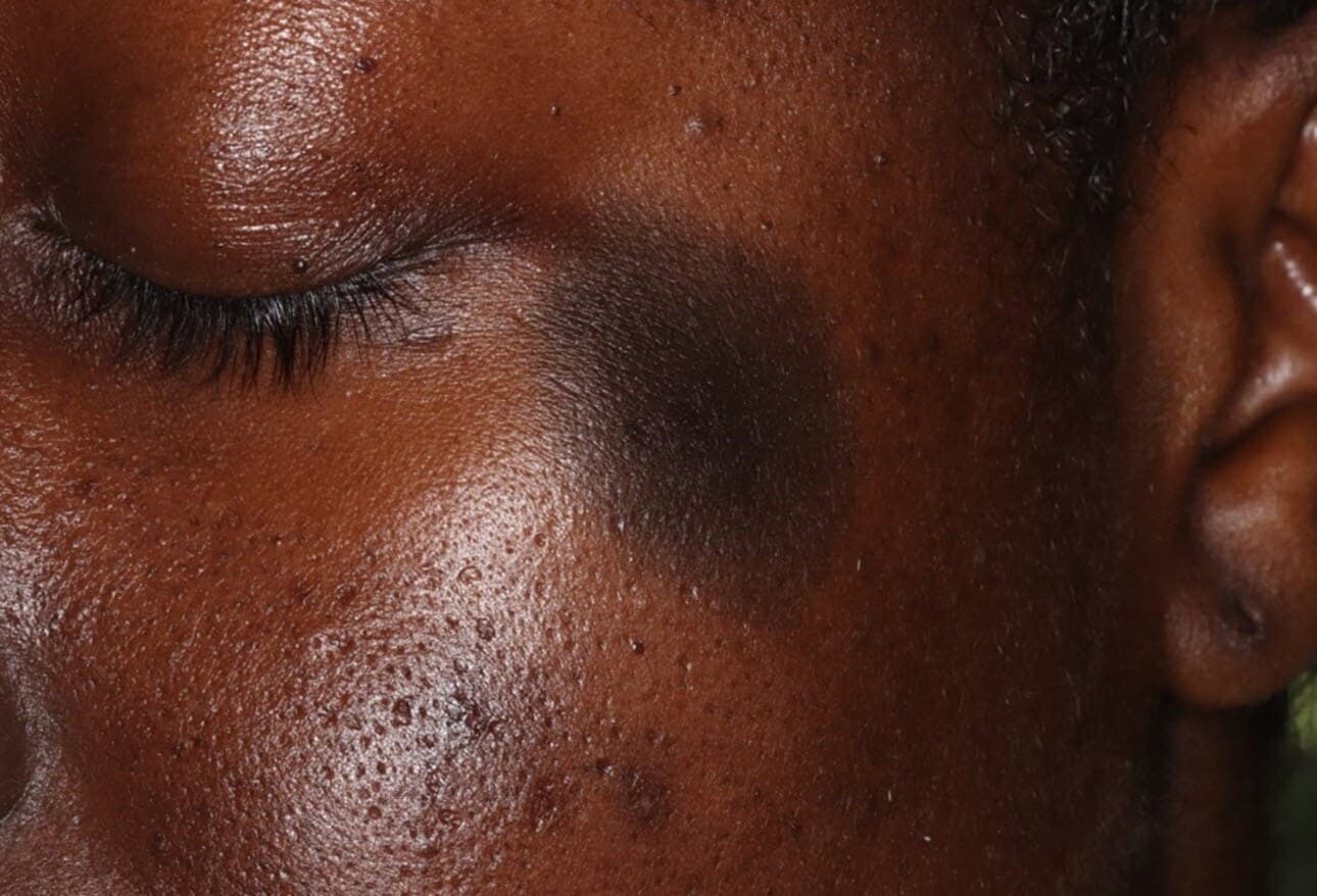 Identifying Lesions on Skin of Color
