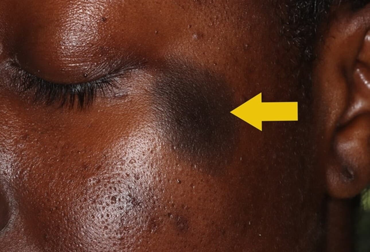 Identifying Lesions on Skin of Color