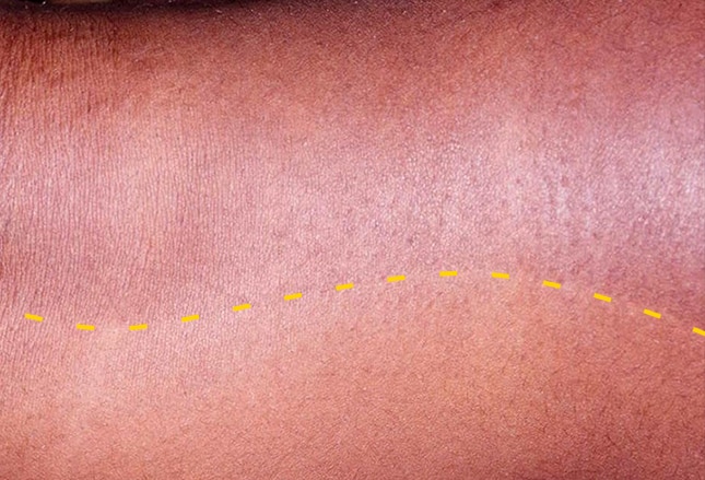 Identifying Lesions on Skin of Color