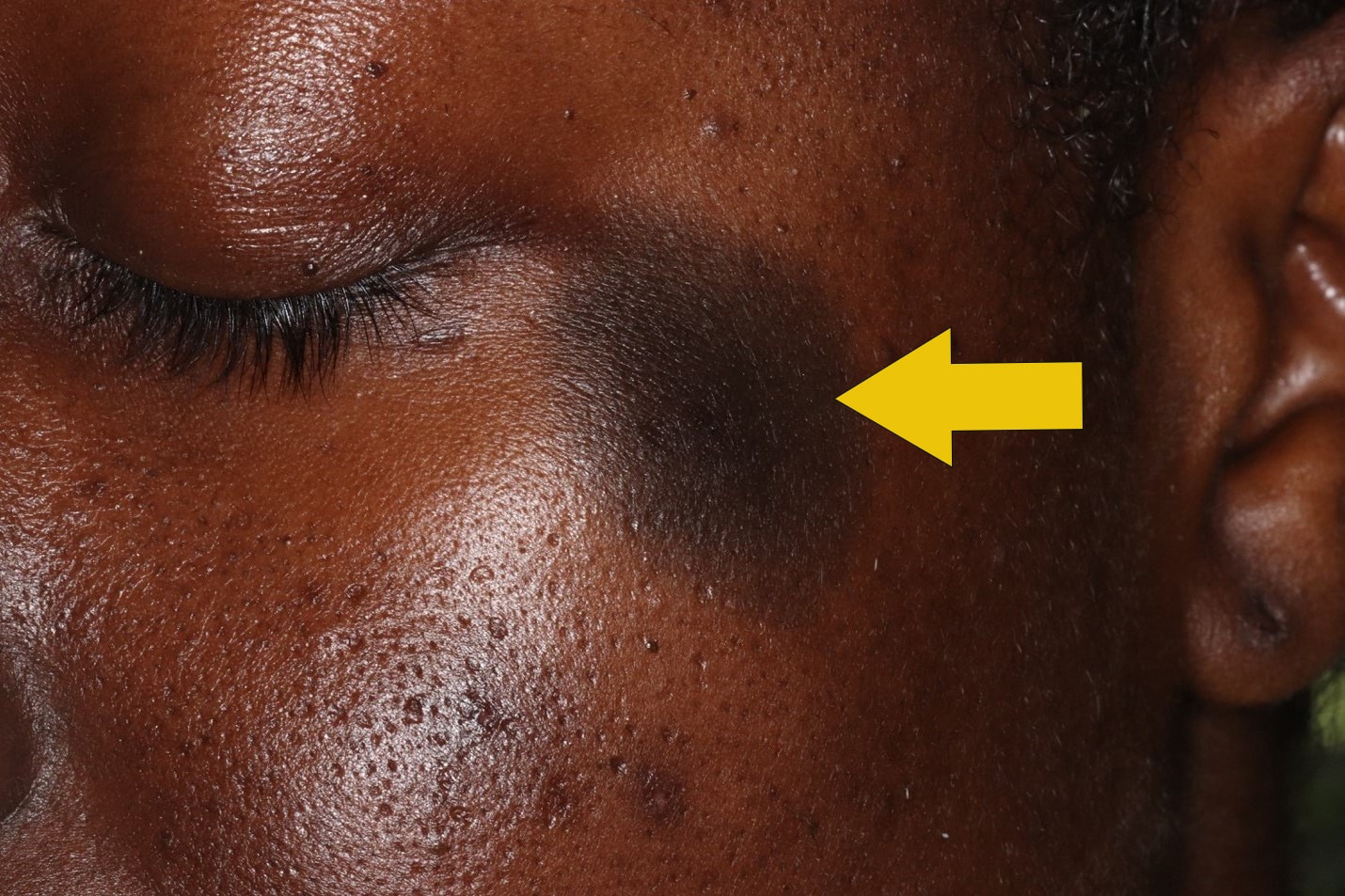 Identifying Lesions on Skin of Color