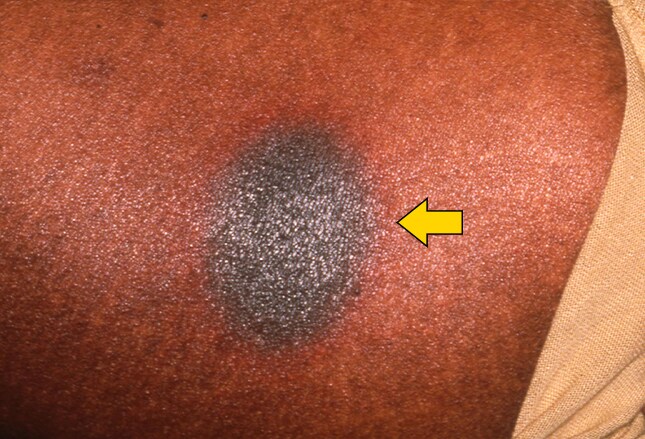 Identifying Lesions on Skin of Color
