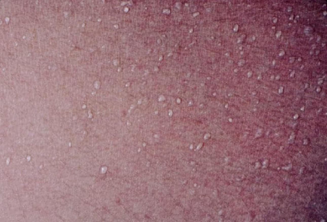 6 Common-to-Rare Infant Skin Conditions