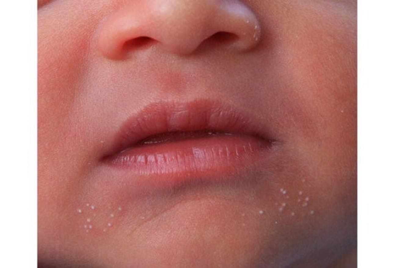 6 Common-to-Rare Infant Skin Conditions
